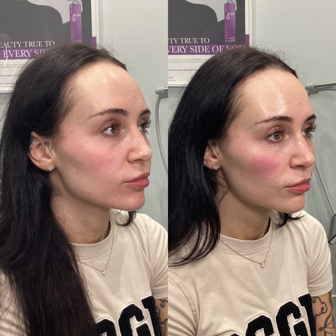 Nasolabial Fold Filler - The Stockbridge Clinic