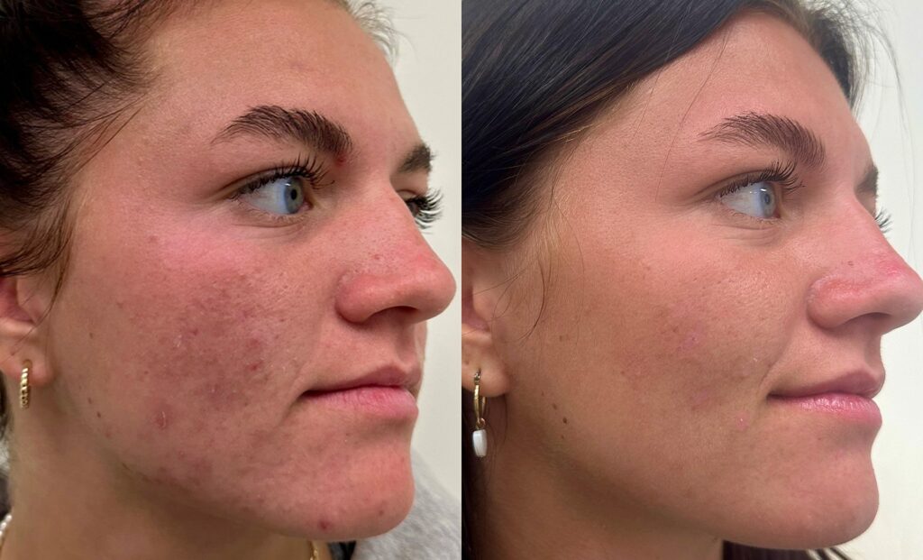 Microneedling In Edinburgh The Stockbridge Clinic Microneedling In Edinburgh The Stockbridge Clinic