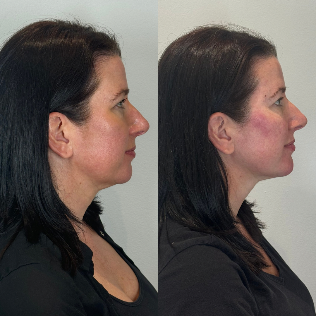 Collagen Biostimulators Restore Skin | Edinburgh Treatments