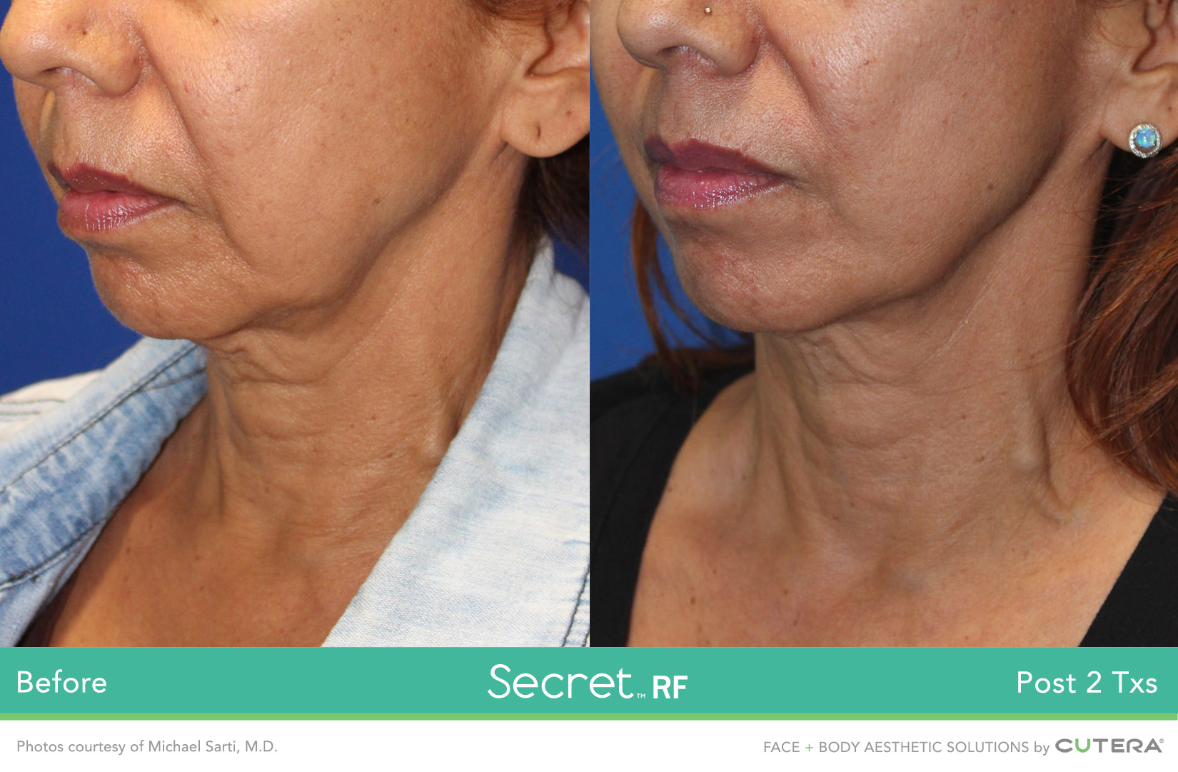 Secret RF Microneedling - The Stockbridge Clinic
