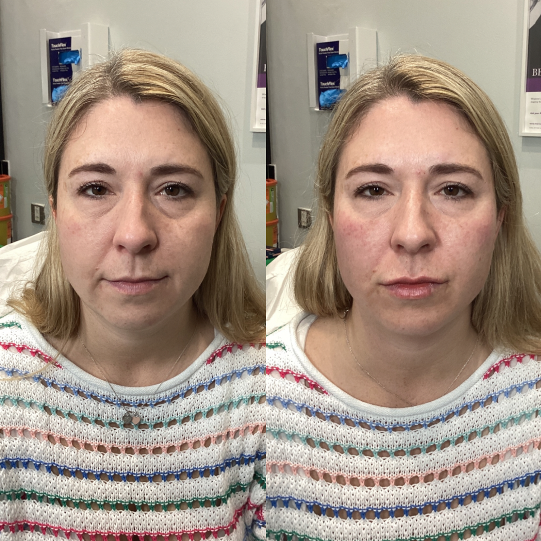 Cheek Filler Edinburgh - Midface | The Stockbridge Clinic