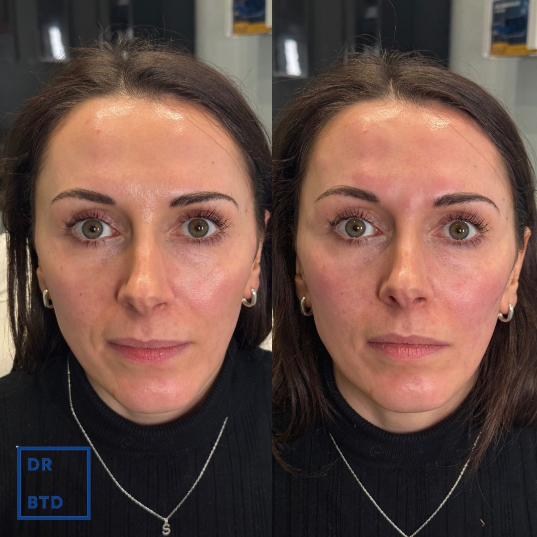 Cheek Filler Edinburgh - Midface | The Stockbridge Clinic